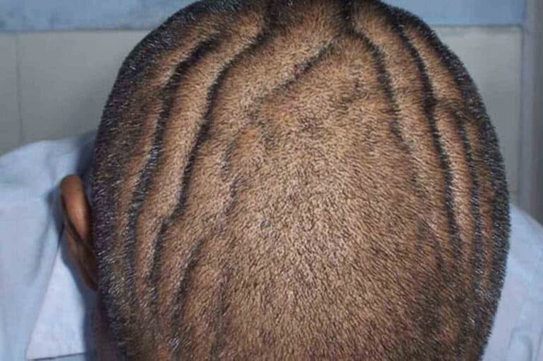 8 Rarest Genetic Mutations in Human - Rarest.org